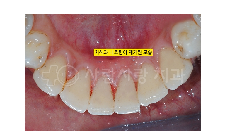 스케일링효과 니코틴착색 잇몸치료방법 잇몸치료란 스켈링비용 스켈링 주의사항 By강남 사람사랑치과 네이버 블로그