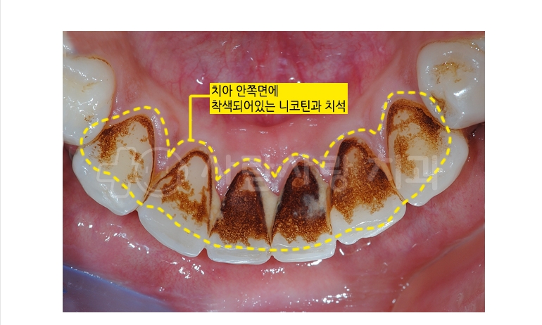 스케일링효과 니코틴착색 잇몸치료방법 잇몸치료란 스켈링비용 스켈링 주의사항 By강남 사람사랑치과 네이버 블로그