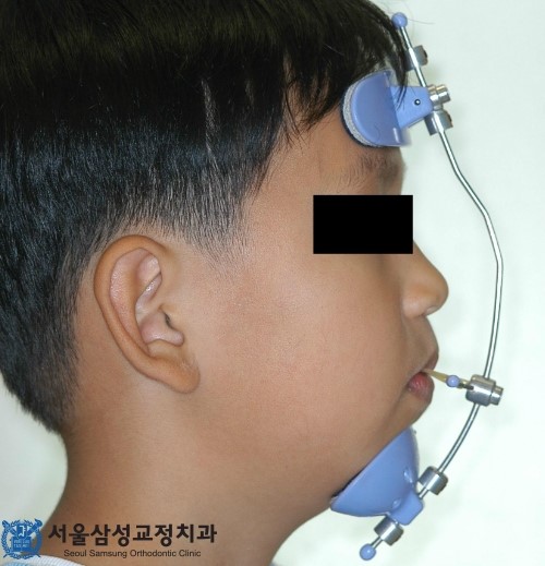 학생시기 성장기 턱교정이 필요한 이유 용인죽전광교 교정전문 수지구청역 서울삼성교정치과 네이버 블로그