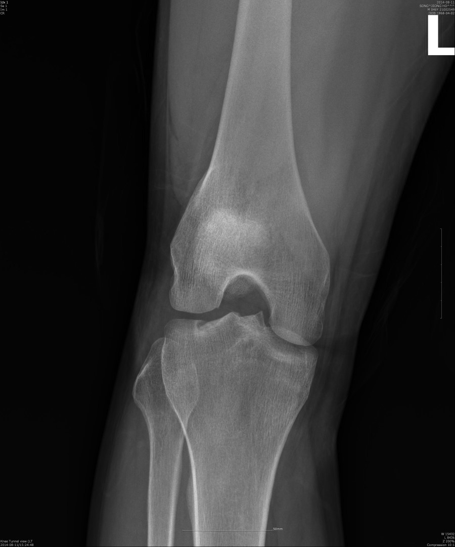 Intercondylar Fossa X Ray