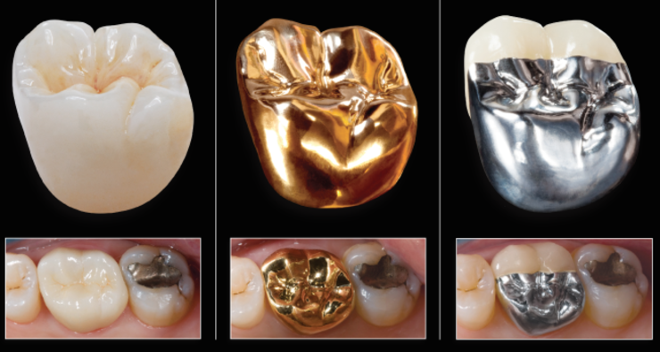 골드 크라운 금니, 치아색 크라운 PFM, 지르코니아 크라운의 장단점 : 네이버 블로그