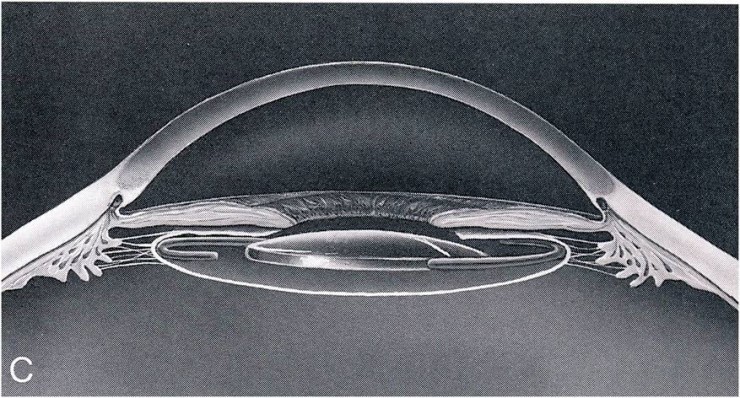 Insertion of Intraocular Lens (IOL) : 네이버 블로그