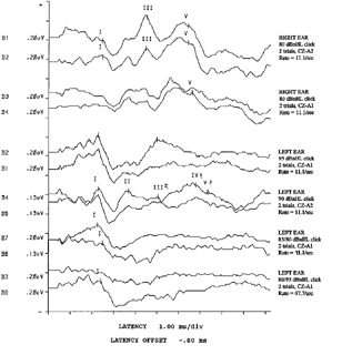 뇌간청각유발검사 Brainstem Auditory Evoked Responses (BAER or ABR) : 네이버 블로그