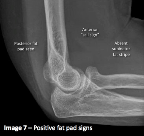 Elbow X-ray의 Fat pad sign : 네이버 블로그
