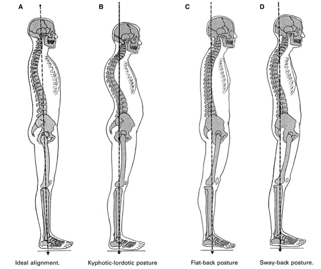 요추와 골반 시상면 정렬의 분류(Roussouly classification) : 네이버 블로그