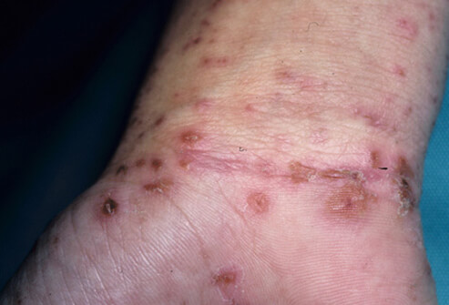 70.[죽전피부과 제이민] 옴(Scabies)/머릿니/옴진드기/린단/lindane/신신린단로션/작틴겔 : 네이버 블로그